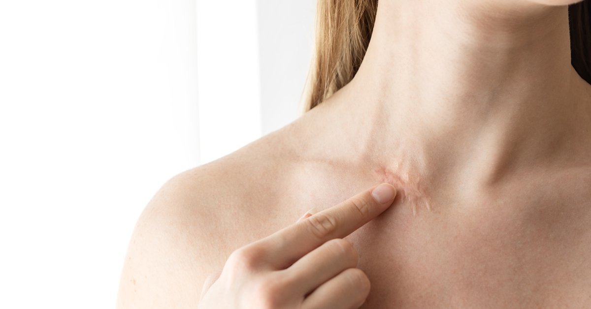 Narben – Tipps für die optimale Pflege